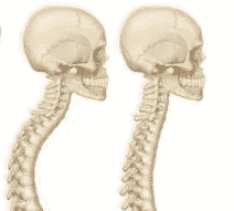 Scolioses, Cyphoses, Lordoses: les réponses du chiropracteur...