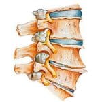 Discarthrose, Discopathie : quels traitements en chiropractie?
